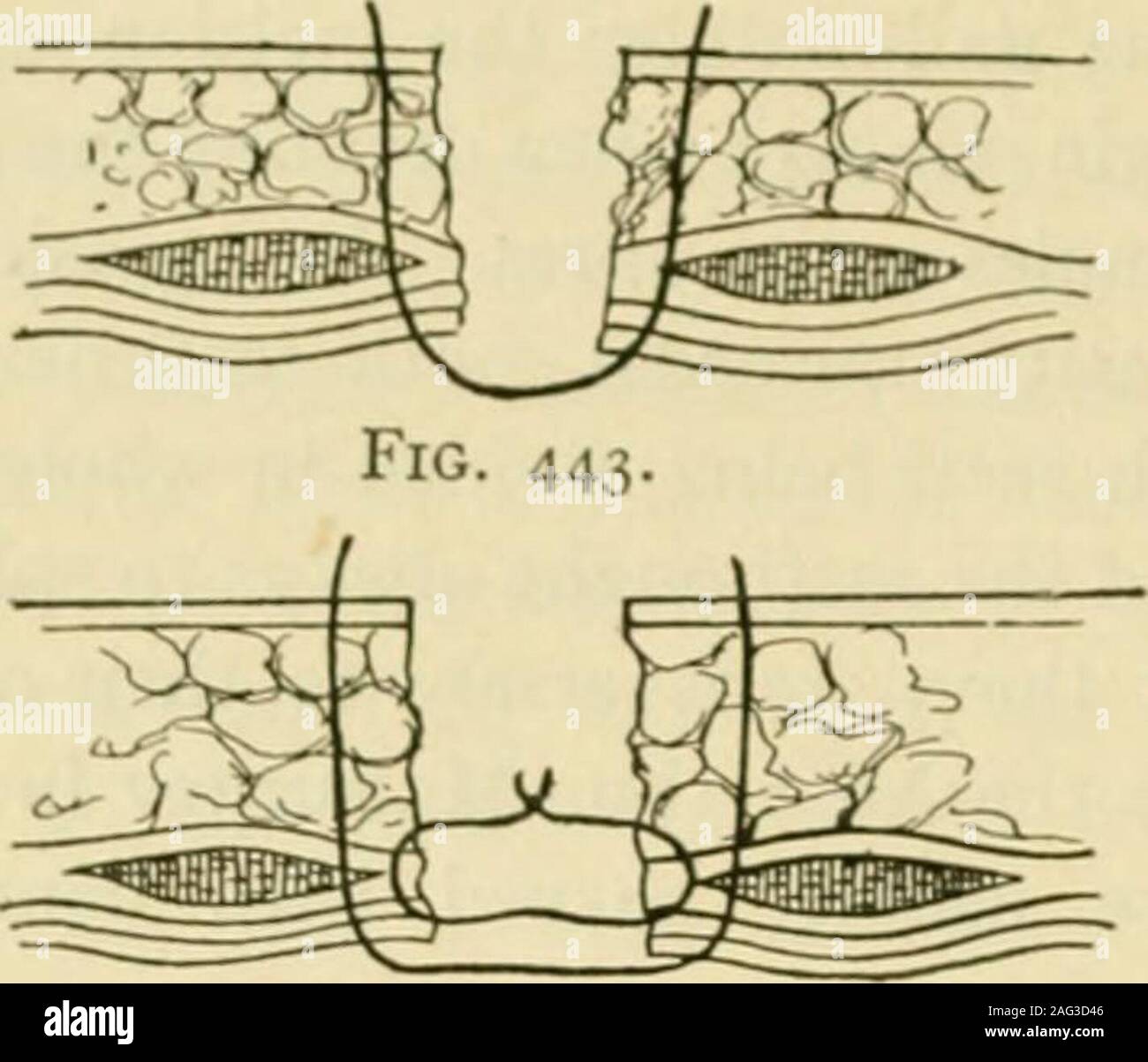 . Manual of operative surgery. to be attained in closing the abdomen is ...