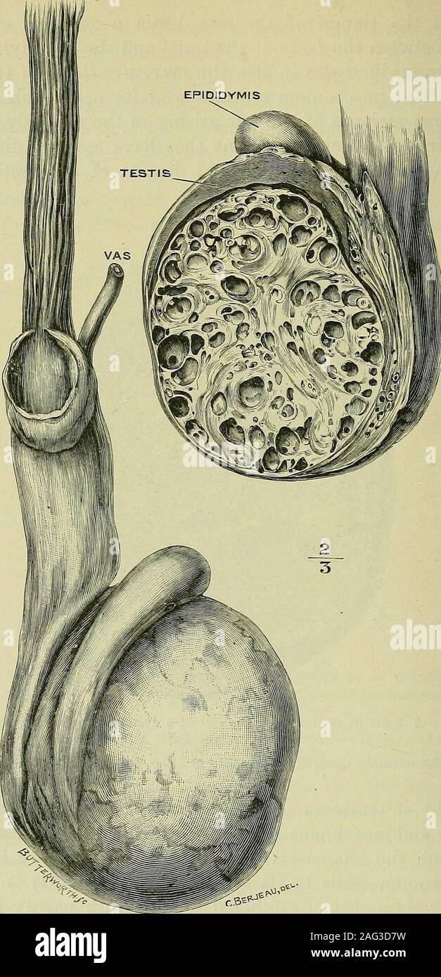 Dermoid hi-res stock photography and images - Alamy
