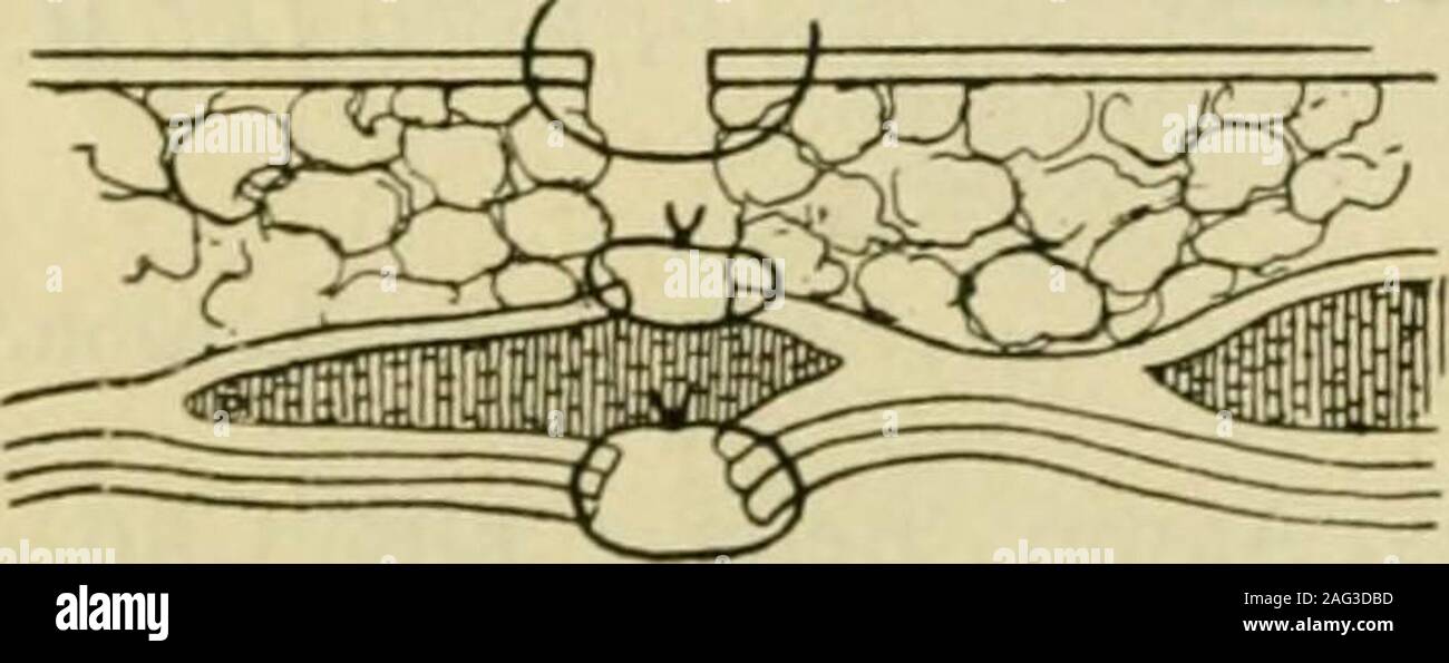 . Manual of operative surgery. rior layer of the rectus sheath. Retract ...