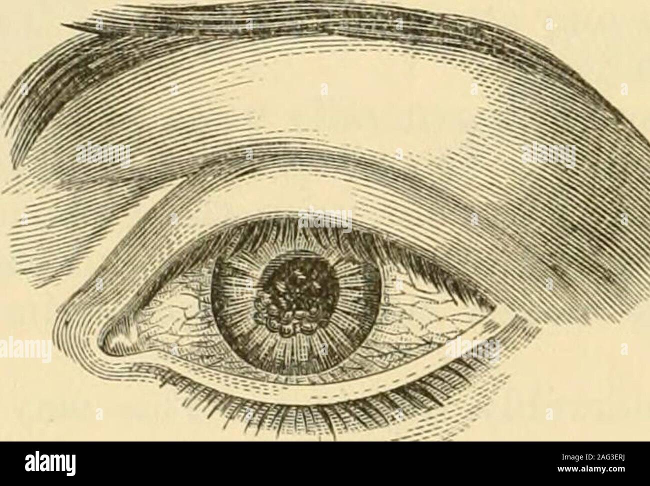 . A treatise on the diseases of the eye. y margin and anterior capsule ...