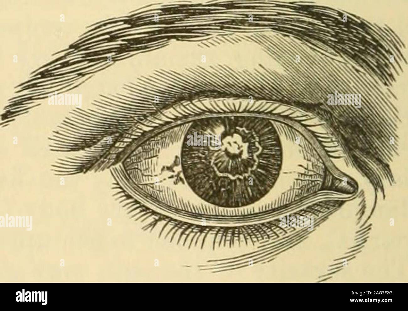 Annular eye hi-res stock photography and images - Alamy