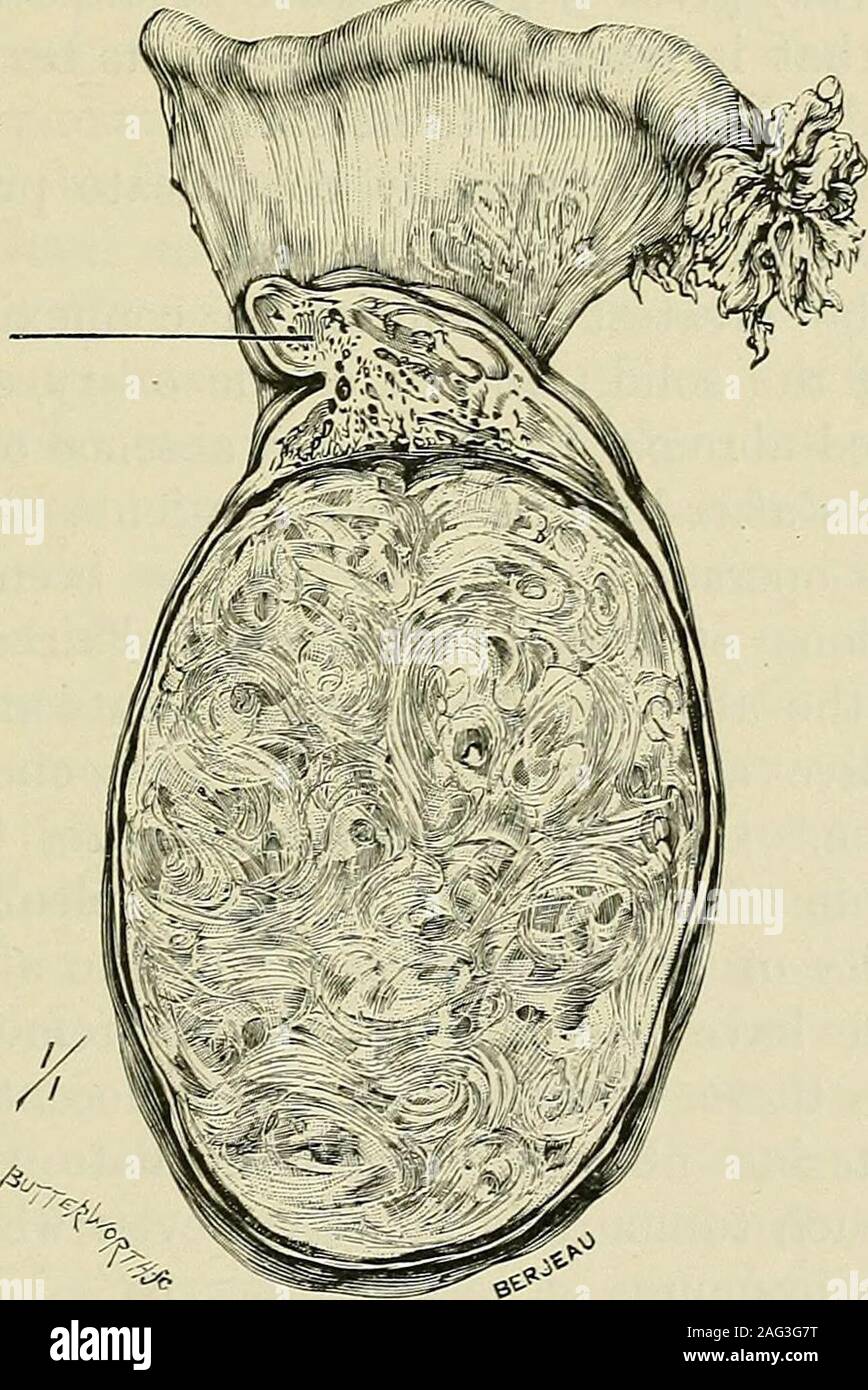 Hydroperitoneum hi-res stock photography and images - Alamy