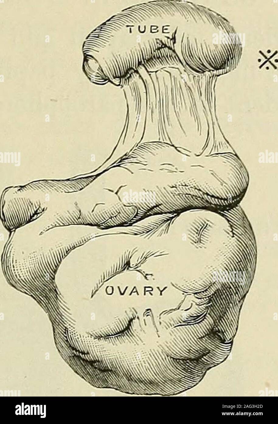 Fluid cysts hi-res stock photography and images - Alamy