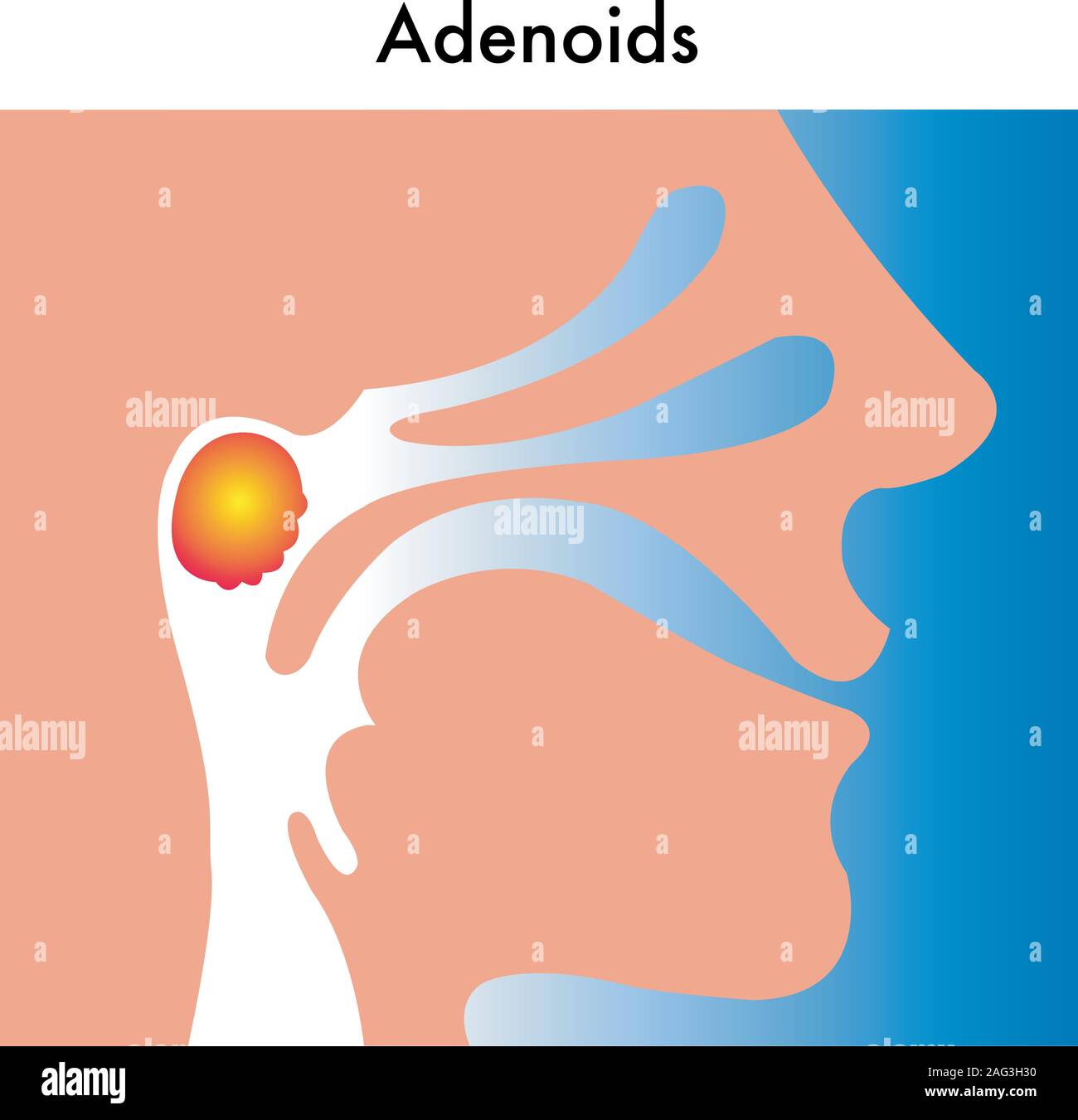 Schematic illustration of the adenoids Stock Vector Image & Art - Alamy Schematic illustration of the adenoids Stock Vector Image & Art - Alamy