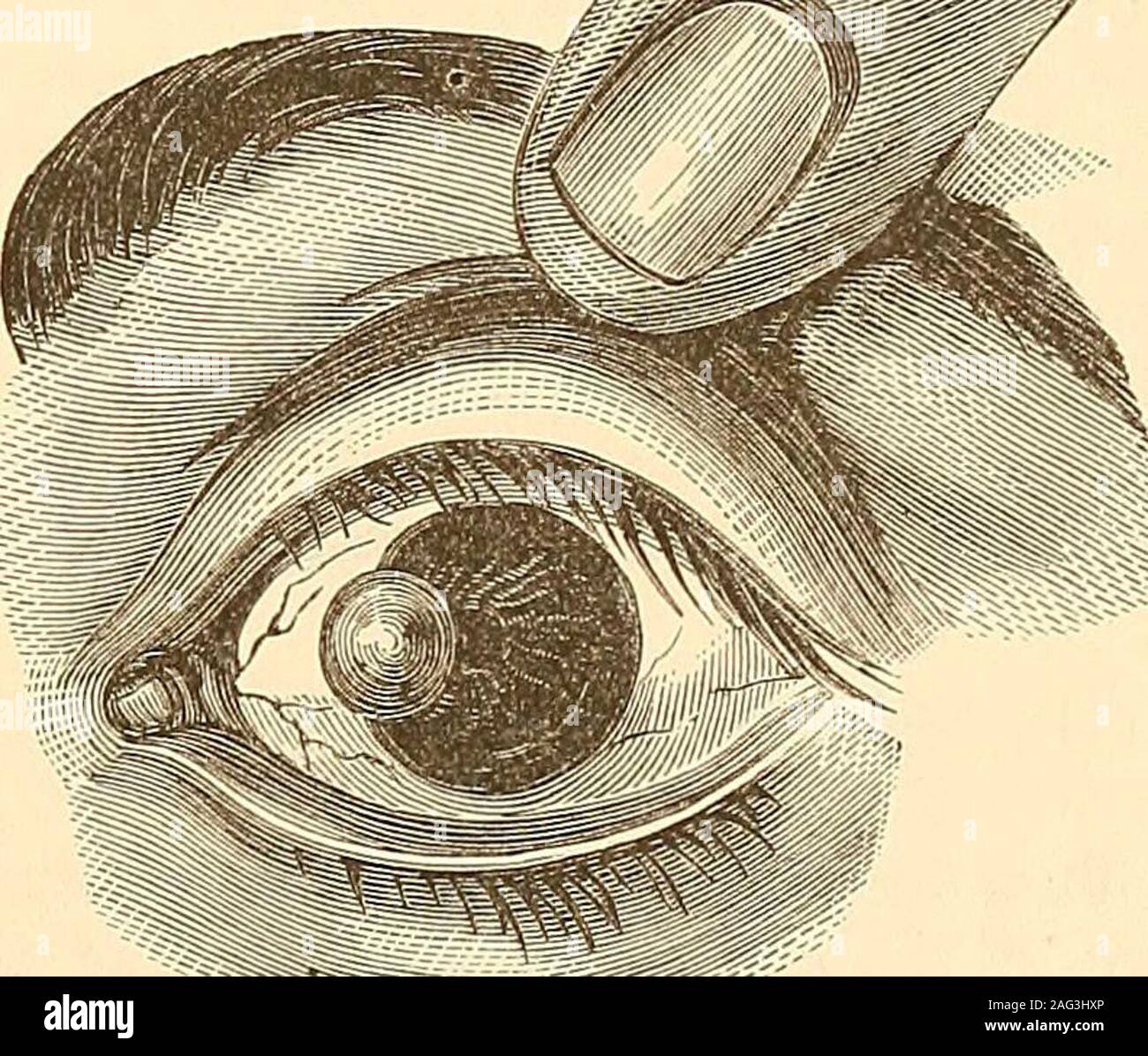 Synechia hi-res stock photography and images - Alamy