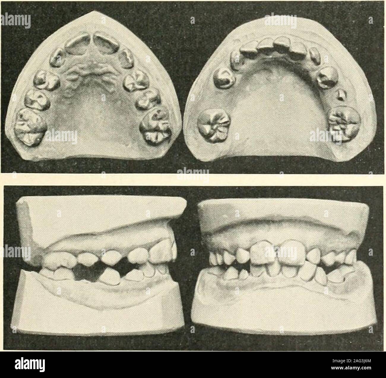 Maxillary incisors hi-res stock photography and images - Alamy