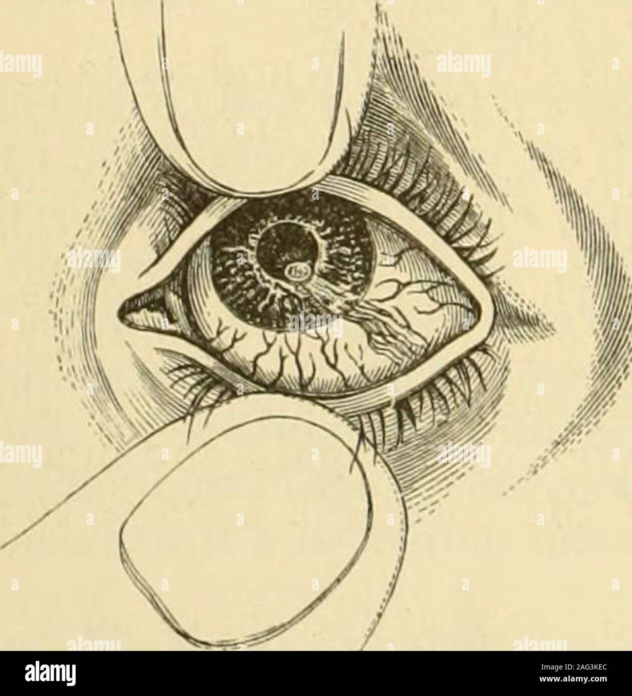 Phlyctenular Conjunctivitis