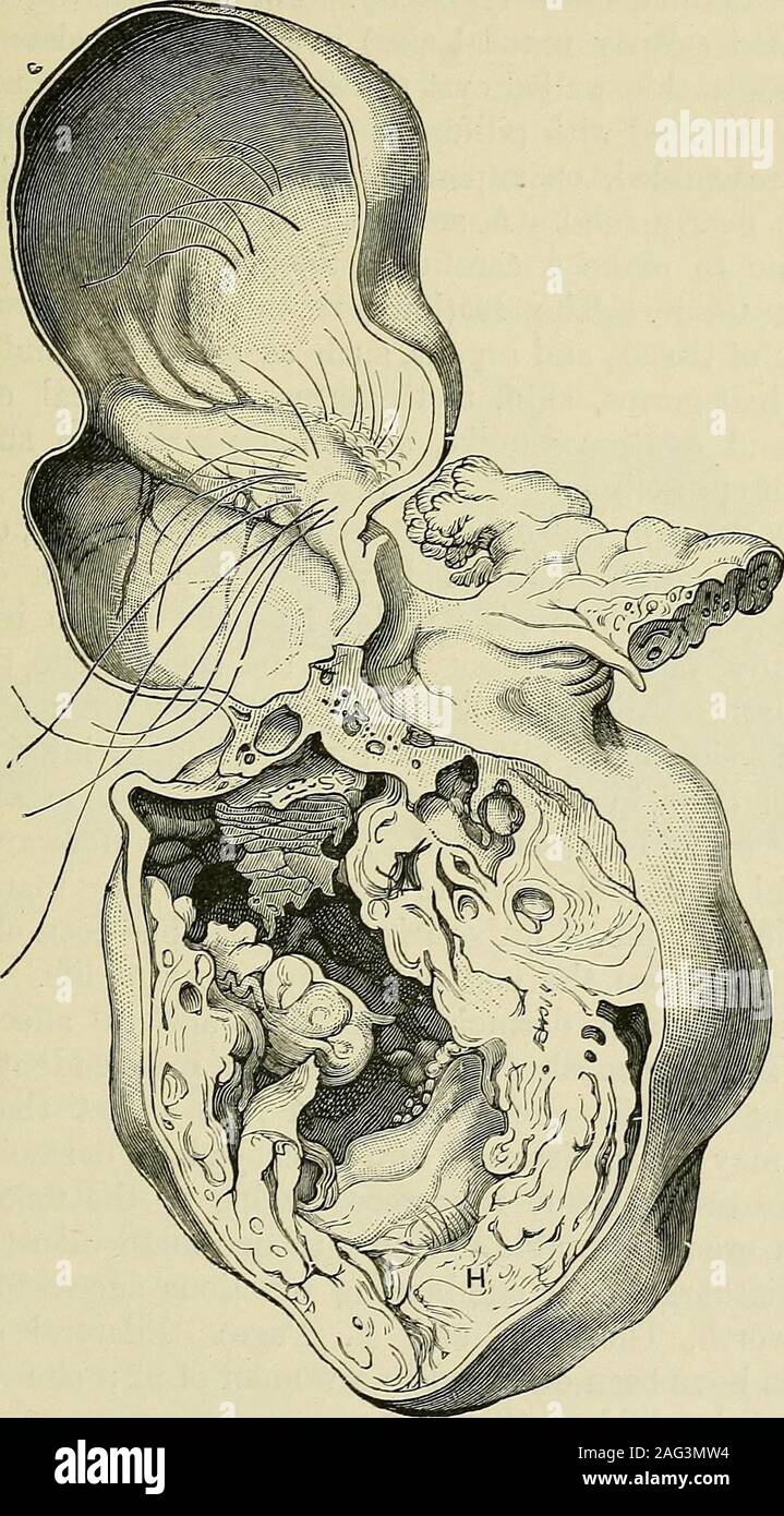 Sebaceous cysts hi-res stock photography and images - Alamy