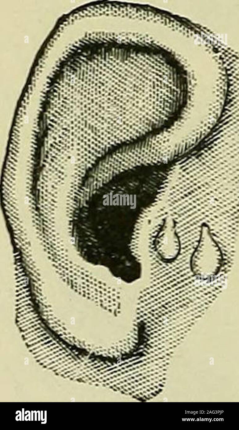 Sebaceous cysts hi-res stock photography and images - Alamy