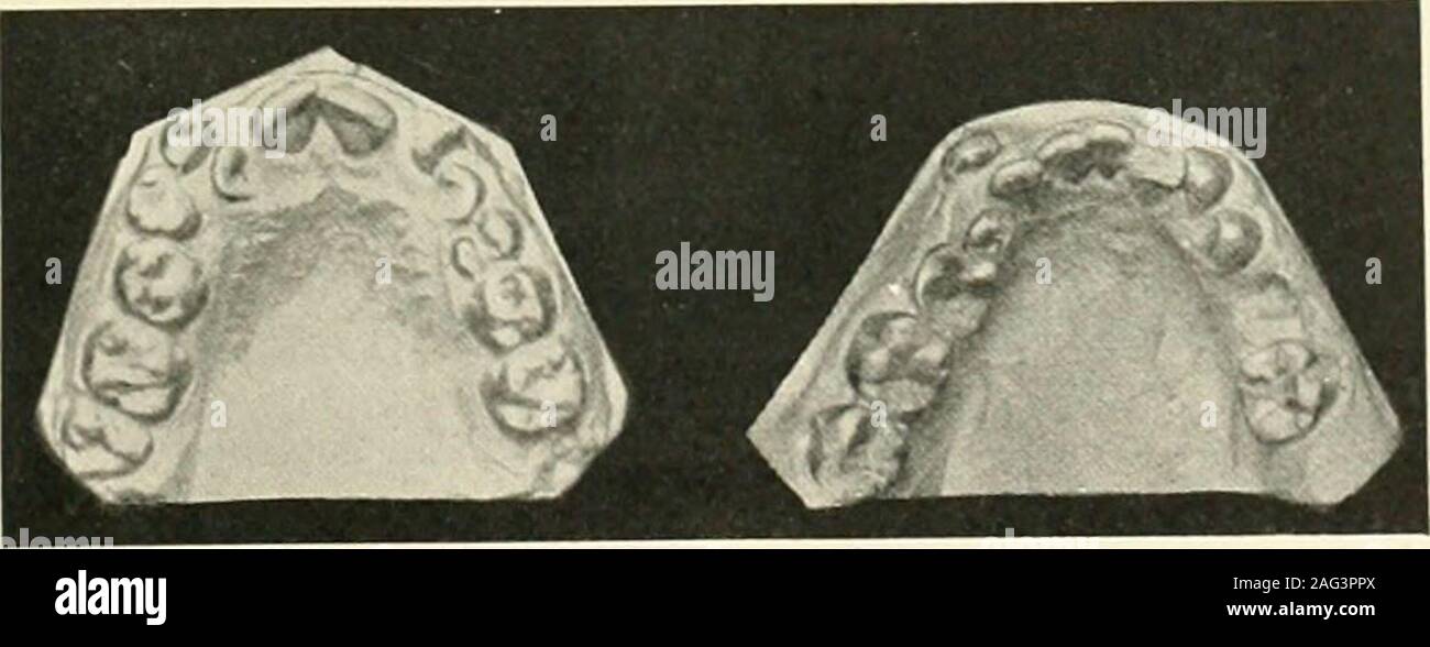 . The science and practice of dental surgery. Forward movement of first ...