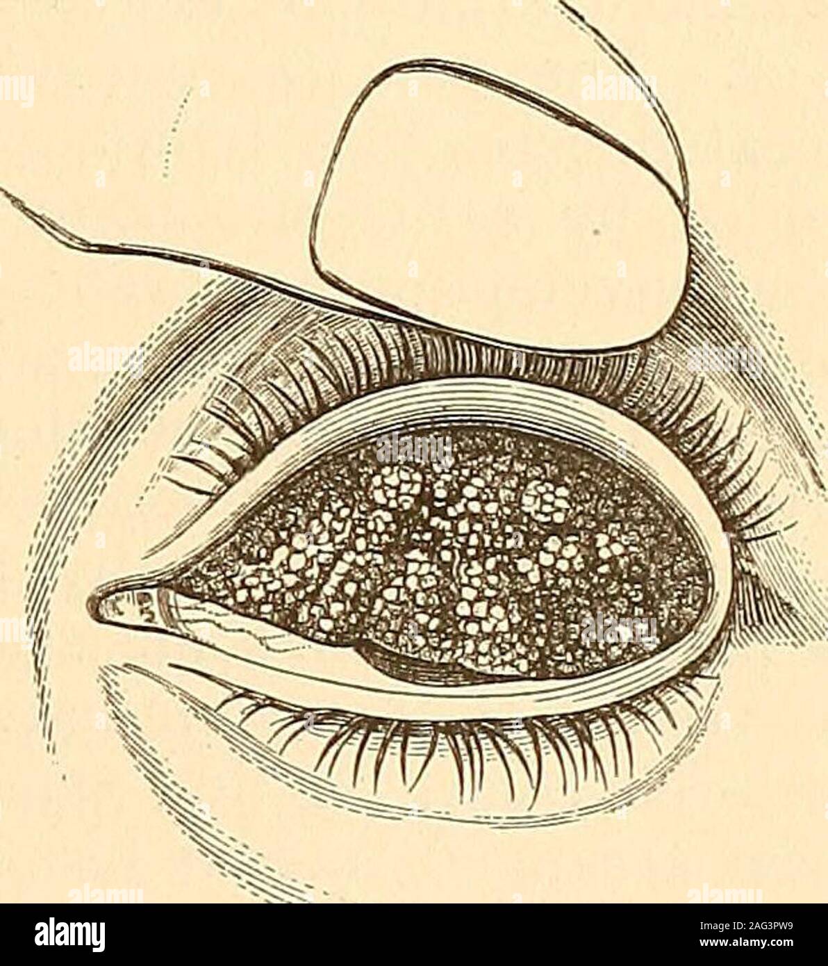 Ophthalmia hi-res stock photography and images - Alamy