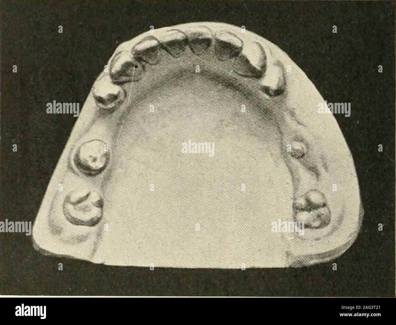 Abnormal bite hi-res stock photography and images - Alamy