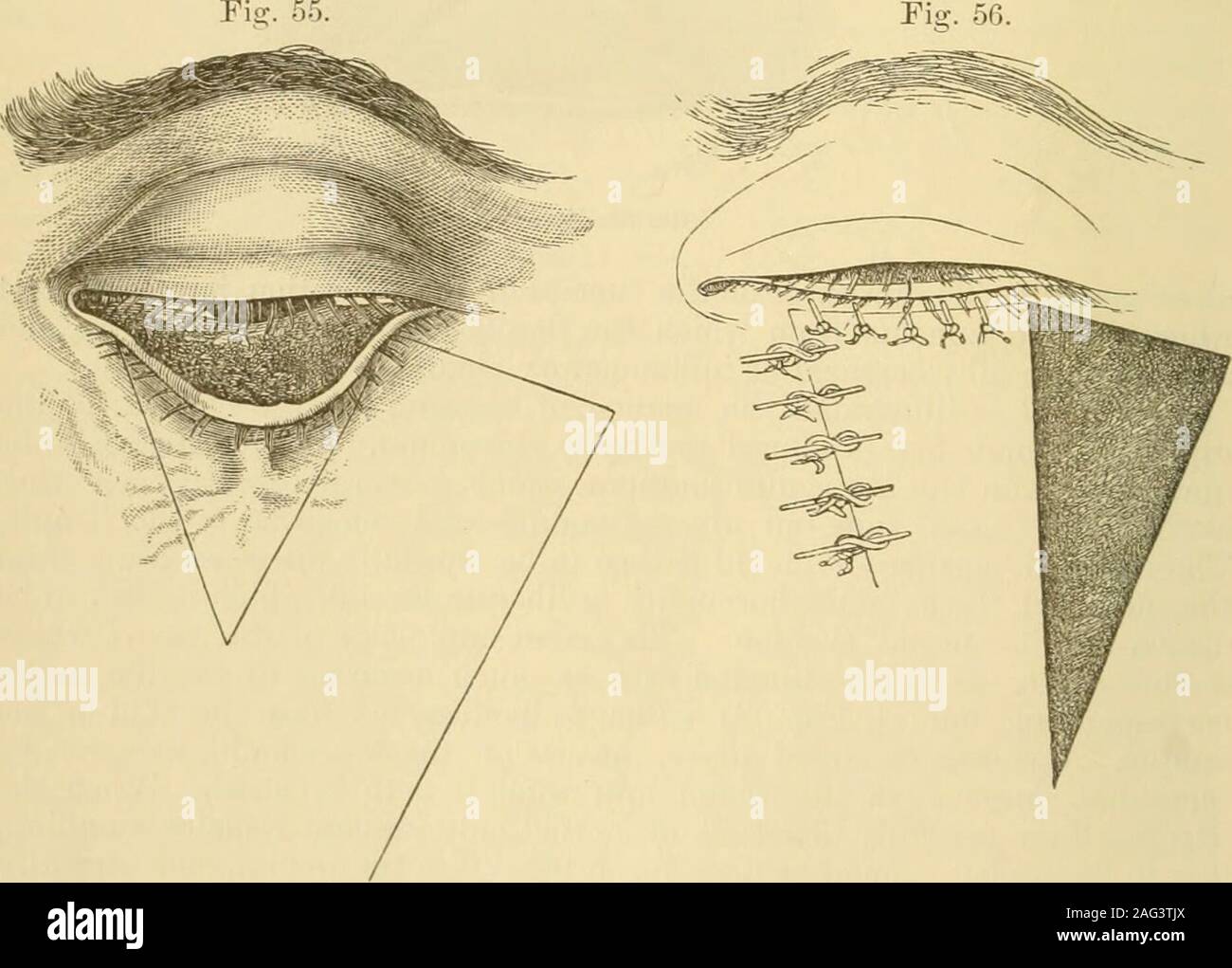 Excised eye hi-res stock photography and images - Alamy