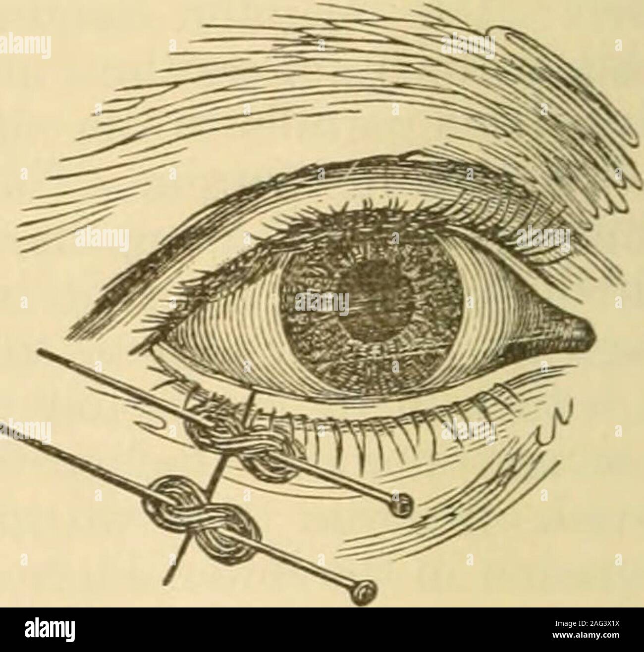 . A treatise on the diseases of the eye. Mr. Wharton Jones operation is ...