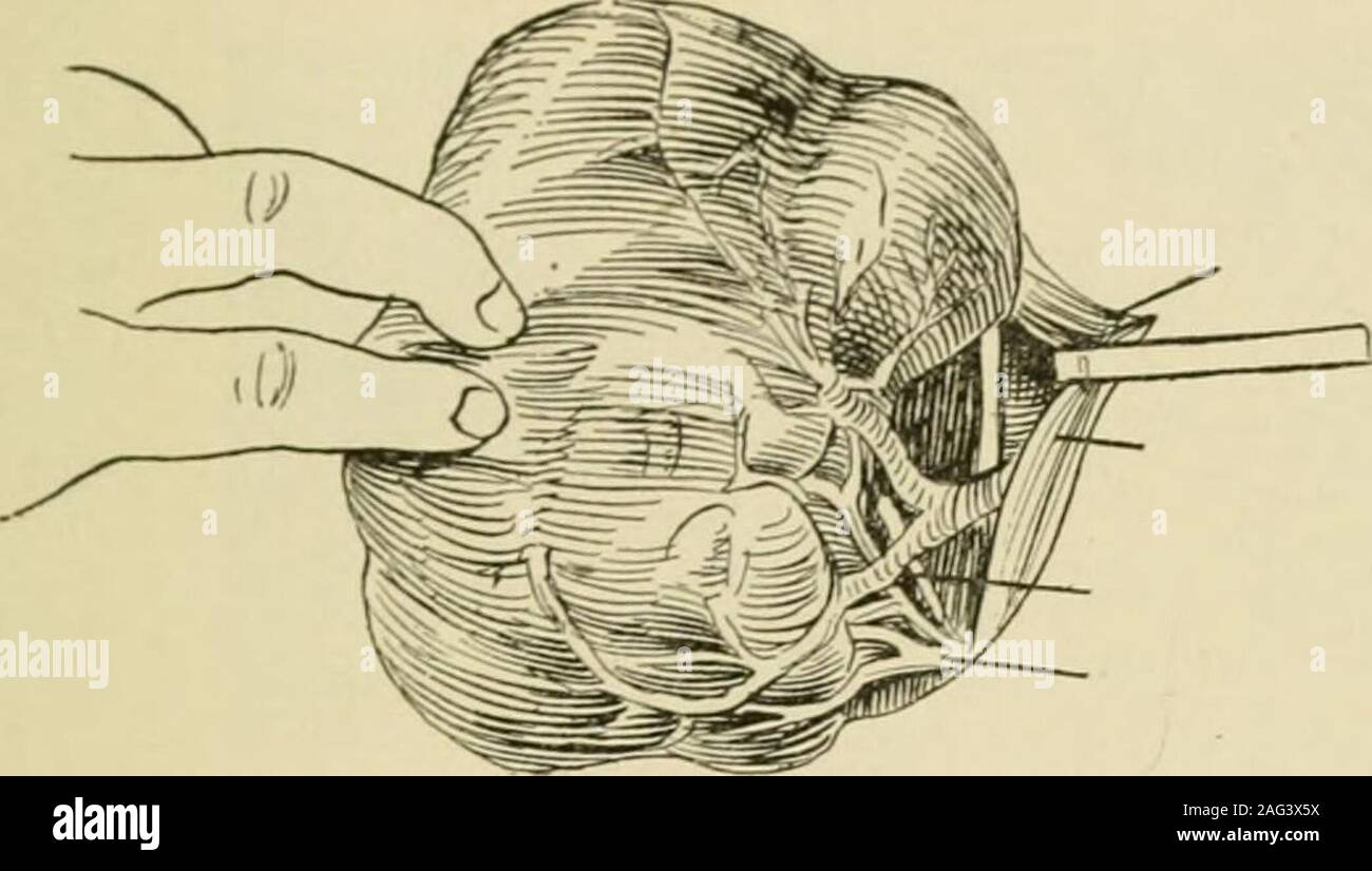 . Manual of operative surgery. 388.—(Kocher.) Fig. 389.—{Kocher.) (c ...