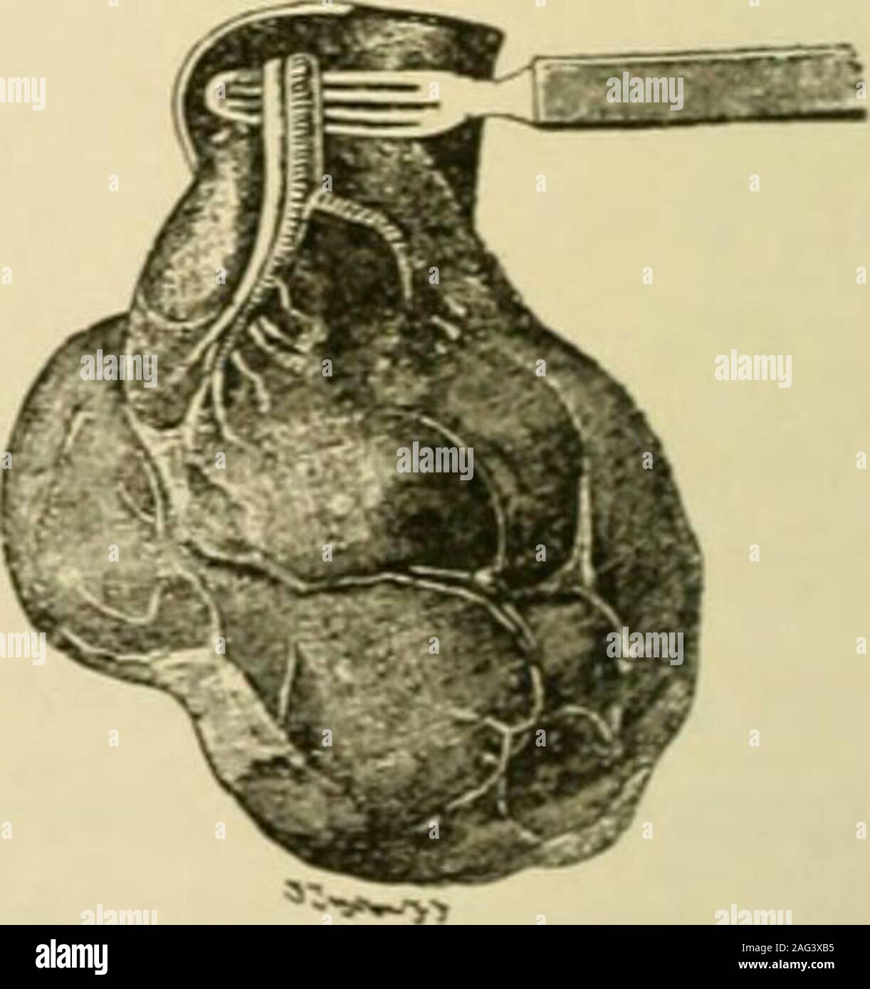 . Manual of operative surgery. 388.—(Kocher.) Fig. 389.—{Kocher.) (c ...