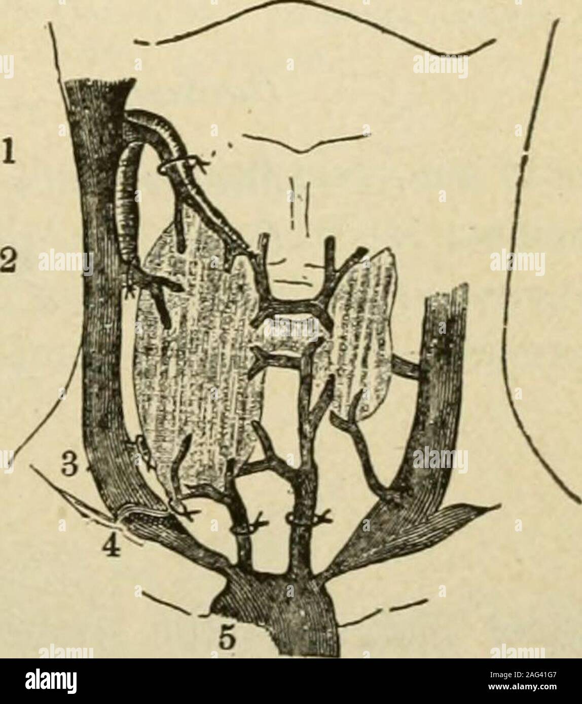 Thyroglossal duct cyst hi-res stock photography and images - Alamy