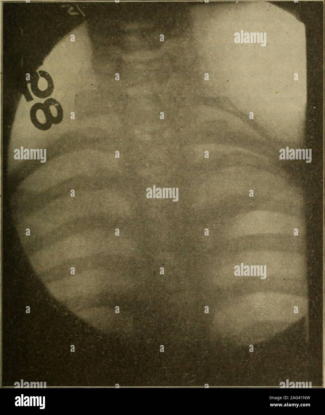 Ulnar neuritis hi-res stock photography and images - Alamy