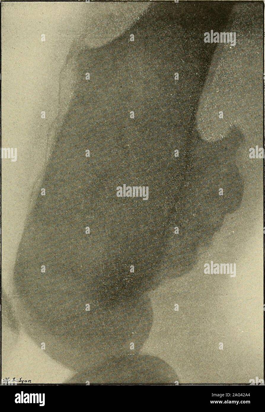 . Des exostoses : (exostoses ostéogéniques, exostoses inflammatoires ...