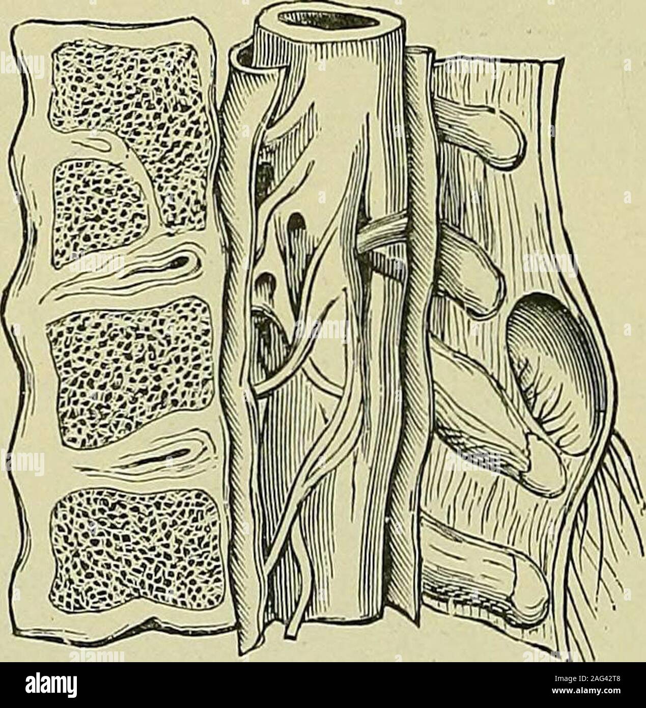 Spina bifida occulta hi-res stock photography and images - Alamy