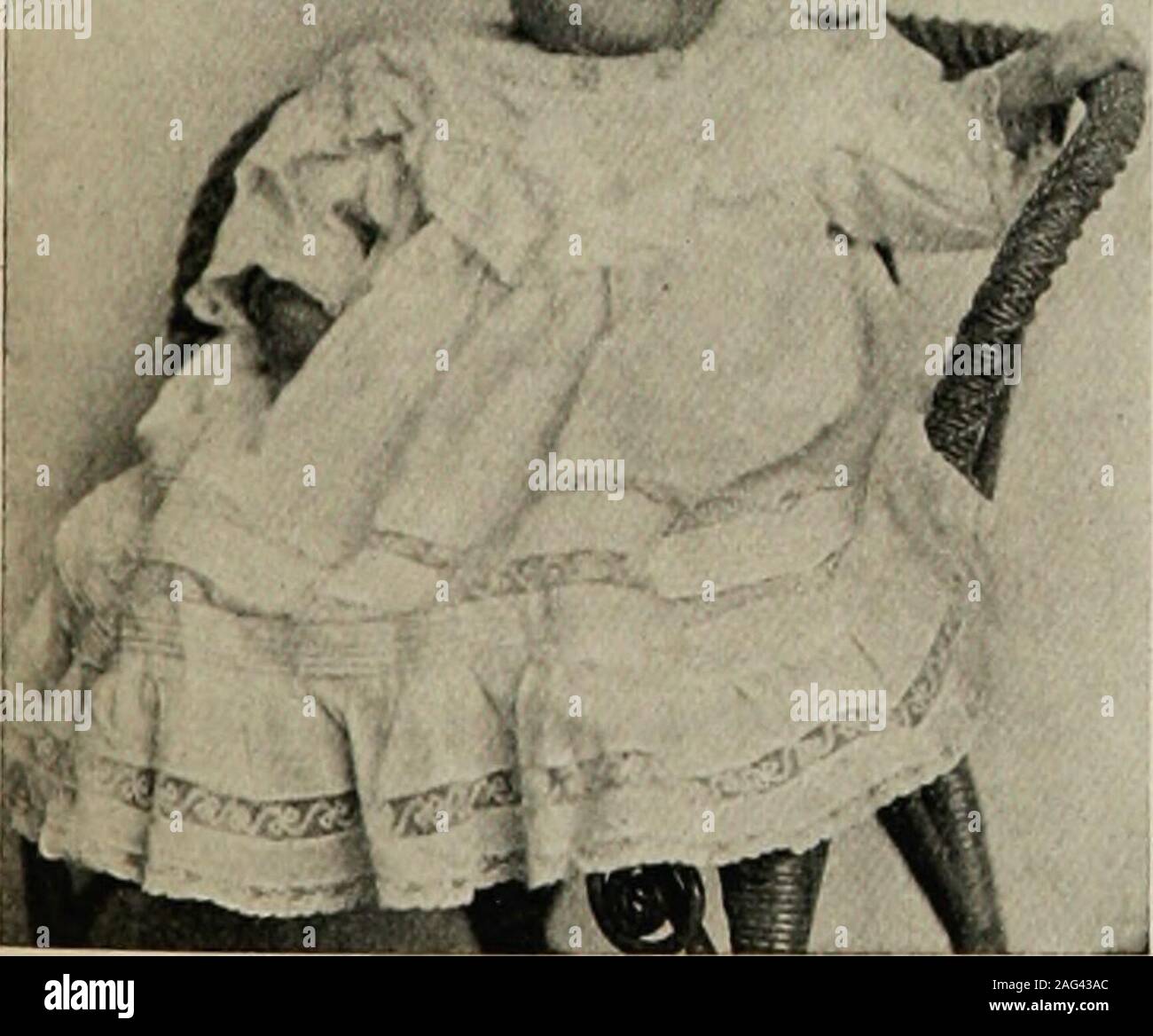 Cretinism myxedema hi-res stock photography and images - Alamy