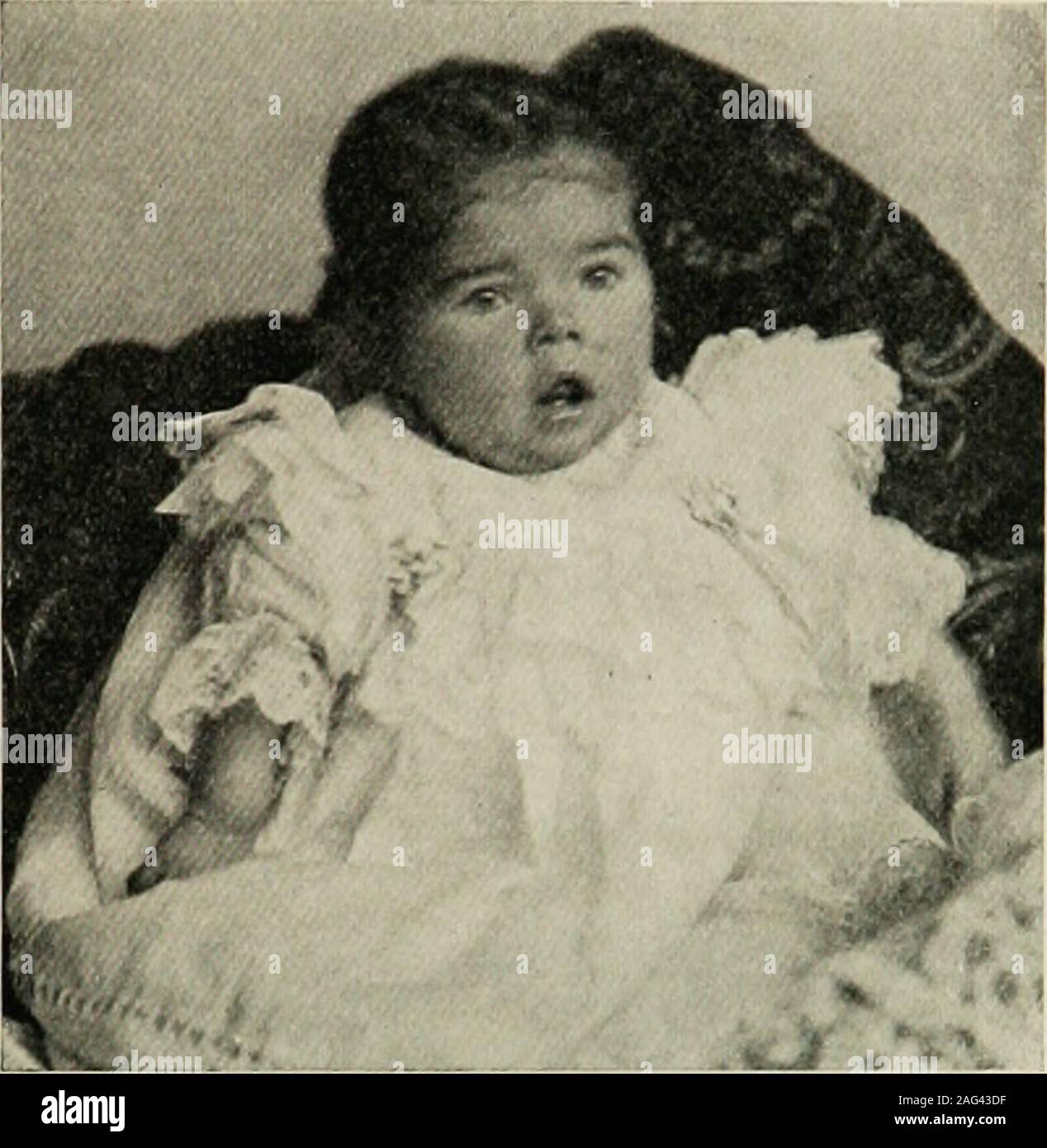 Cretinism myxedema hi-res stock photography and images - Alamy