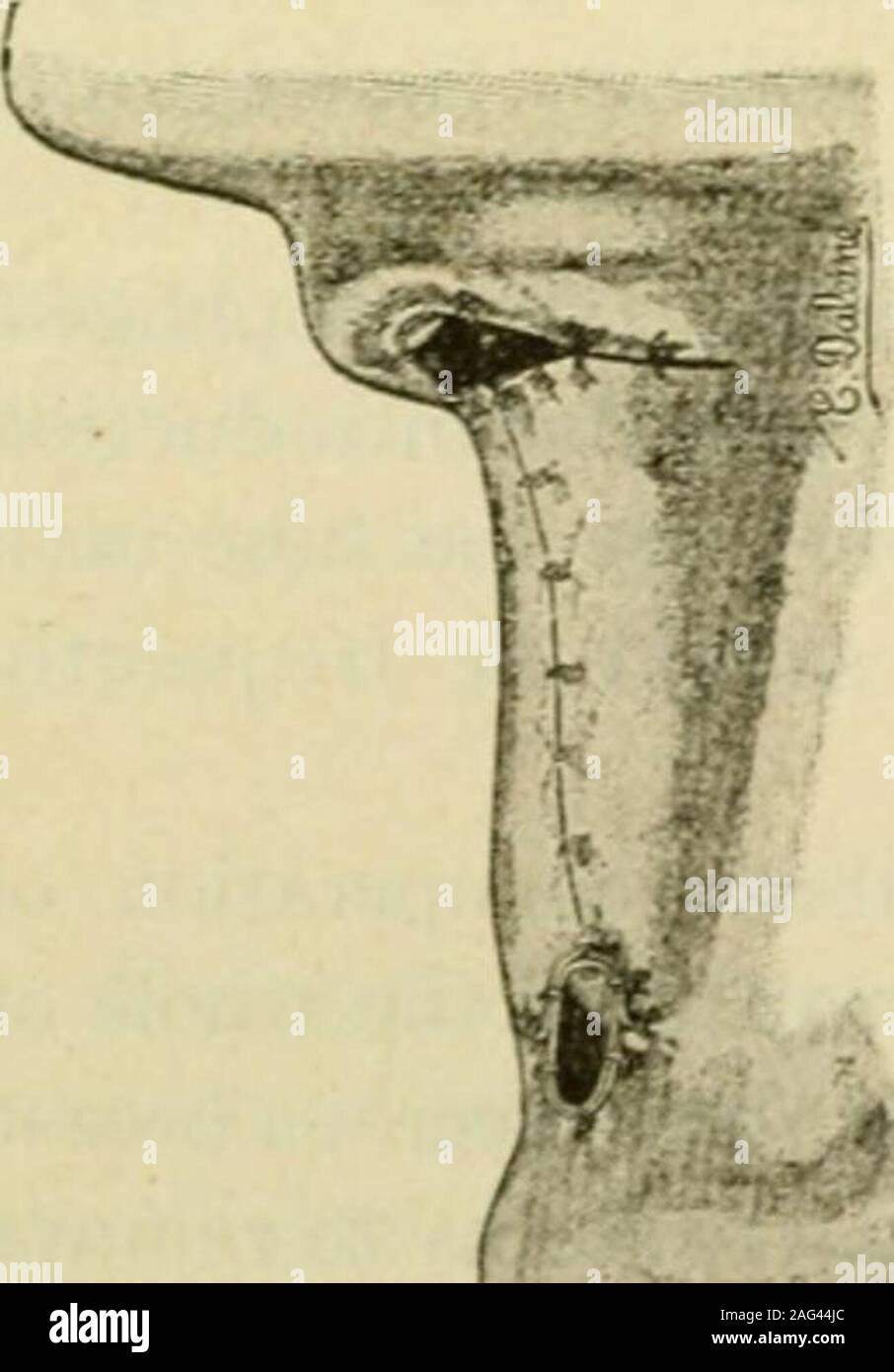 . Manual of operative surgery. the wound with sutures after providing ...