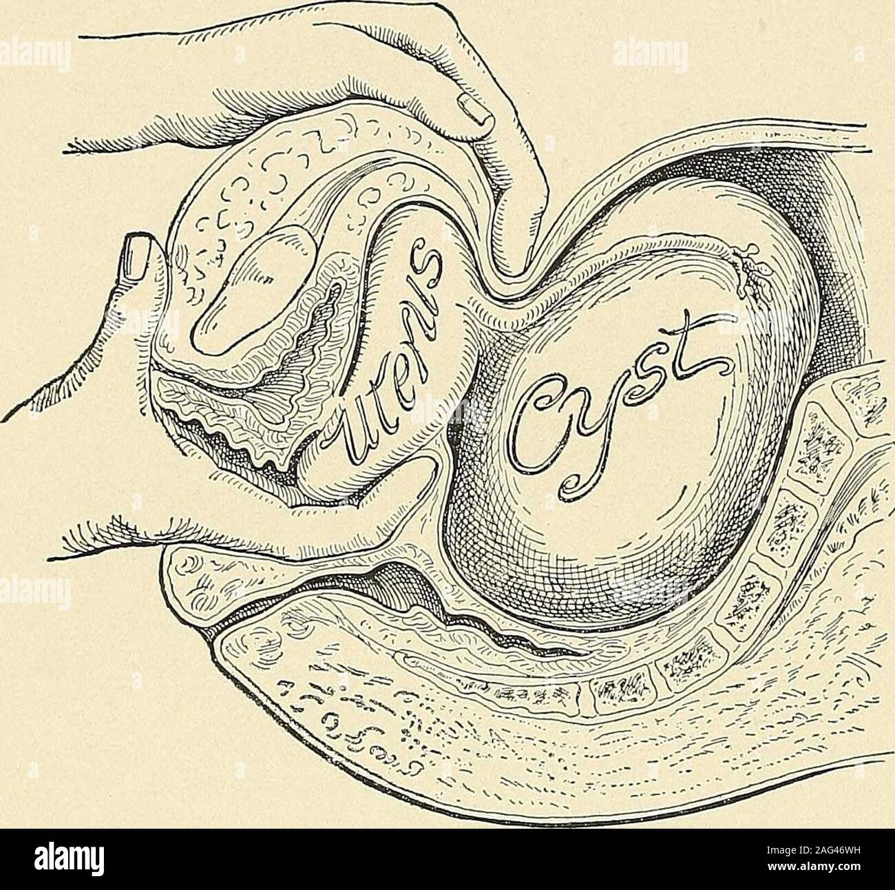 . The diagnosis and treatment of diseases of women. Fig. 84. Mechod of ...