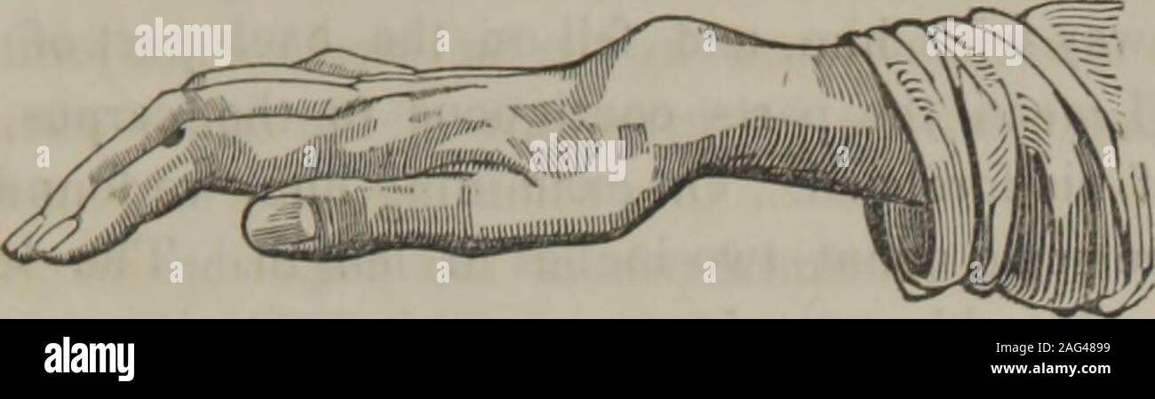 . A treatise on dislocations and fractures of the joints. g, putsout ...
