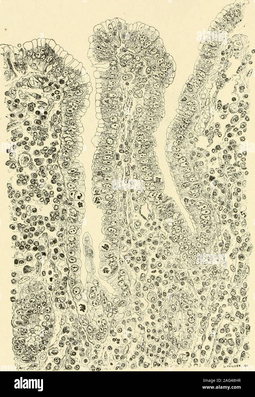 Adenoid tissue hi-res stock photography and images - Alamy