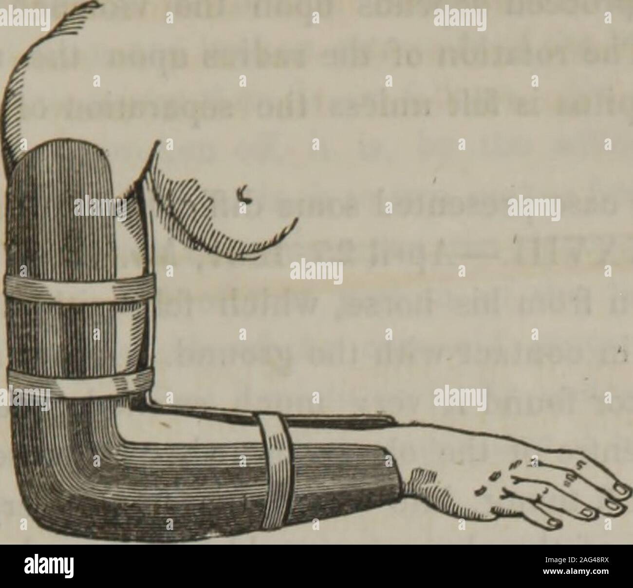 Fracture olecranon process of ulna hi-res stock photography and images ...