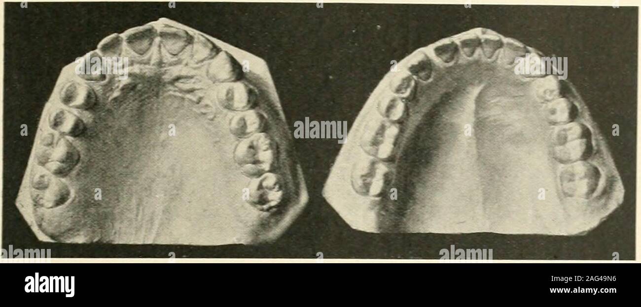 . The science and practice of dental surgery. Fig. ll-l.—Small teeth in ...