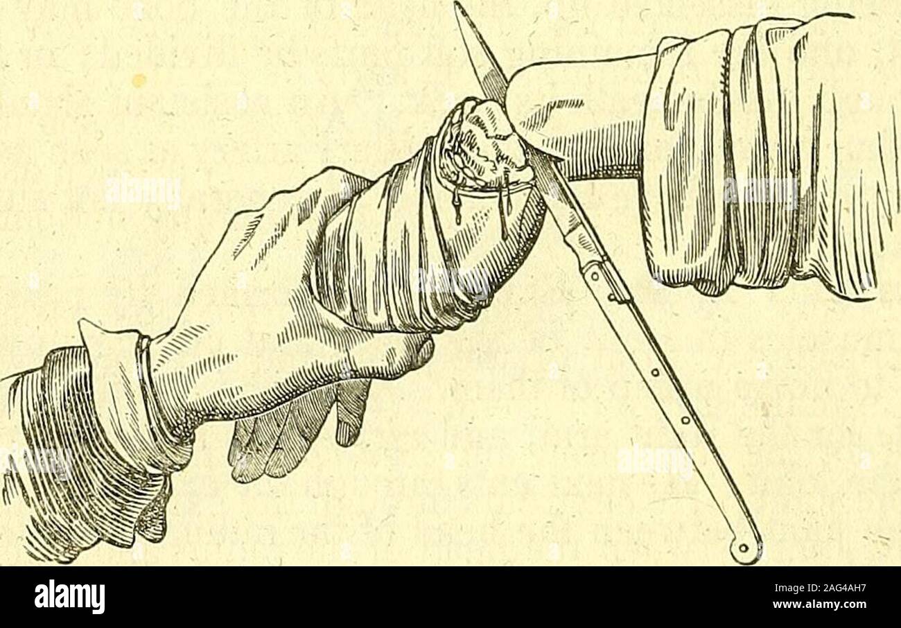 . The principles and practice of modern surgery. cut through, and the ...