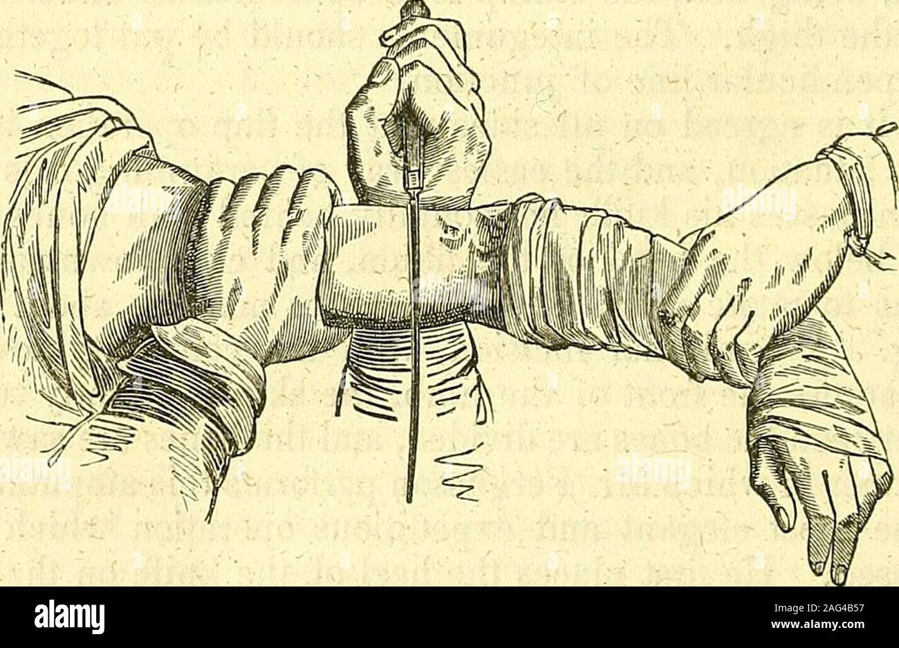 . The principles and practice of modern surgery. IV. Amputation of the ...