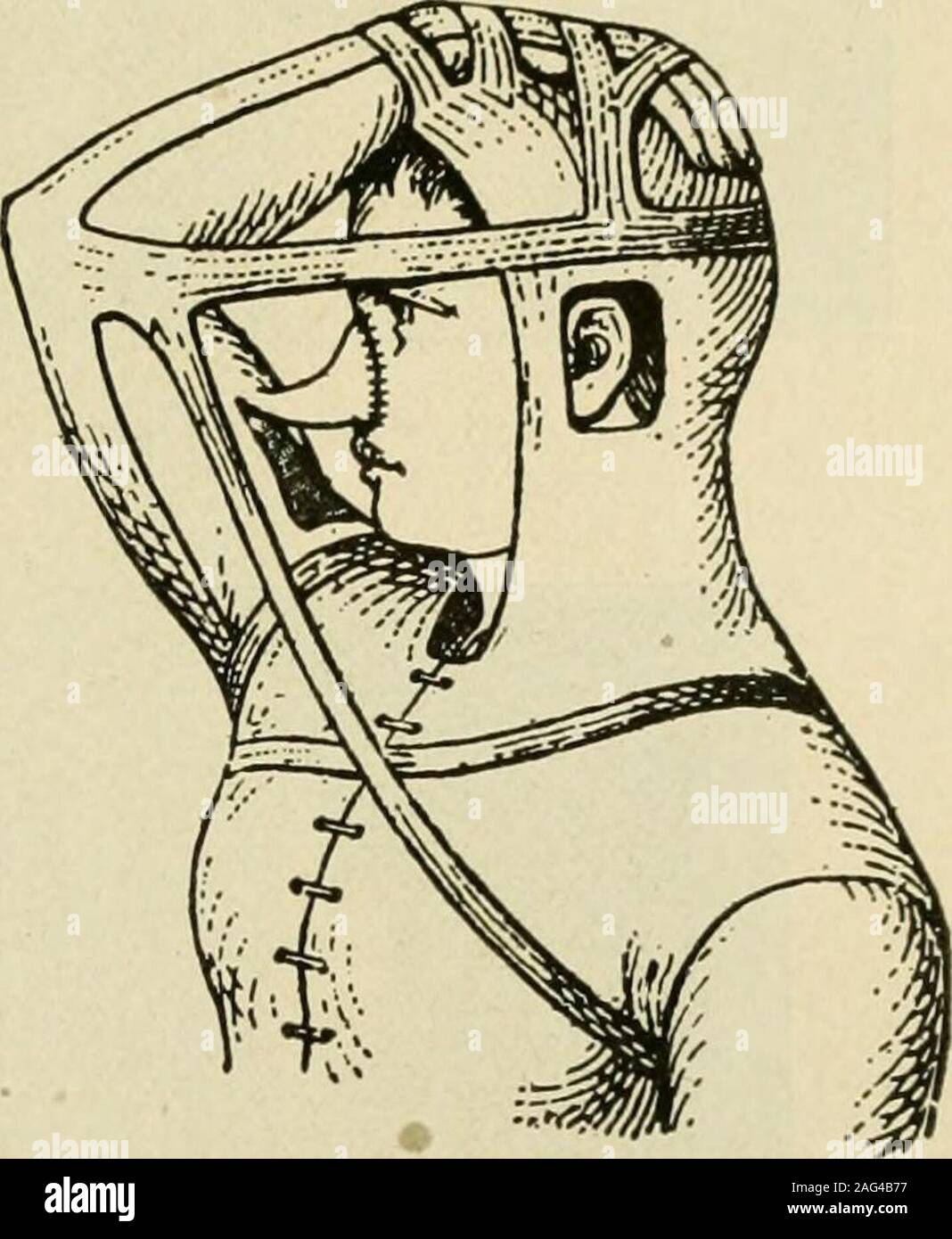 . Manual of operative surgery. bone at the root of the nose. Apply warm ...