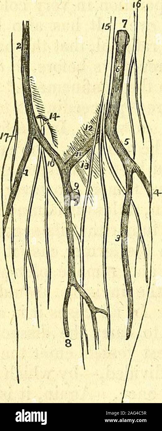 Venesection hi-res stock photography and images - Alamy