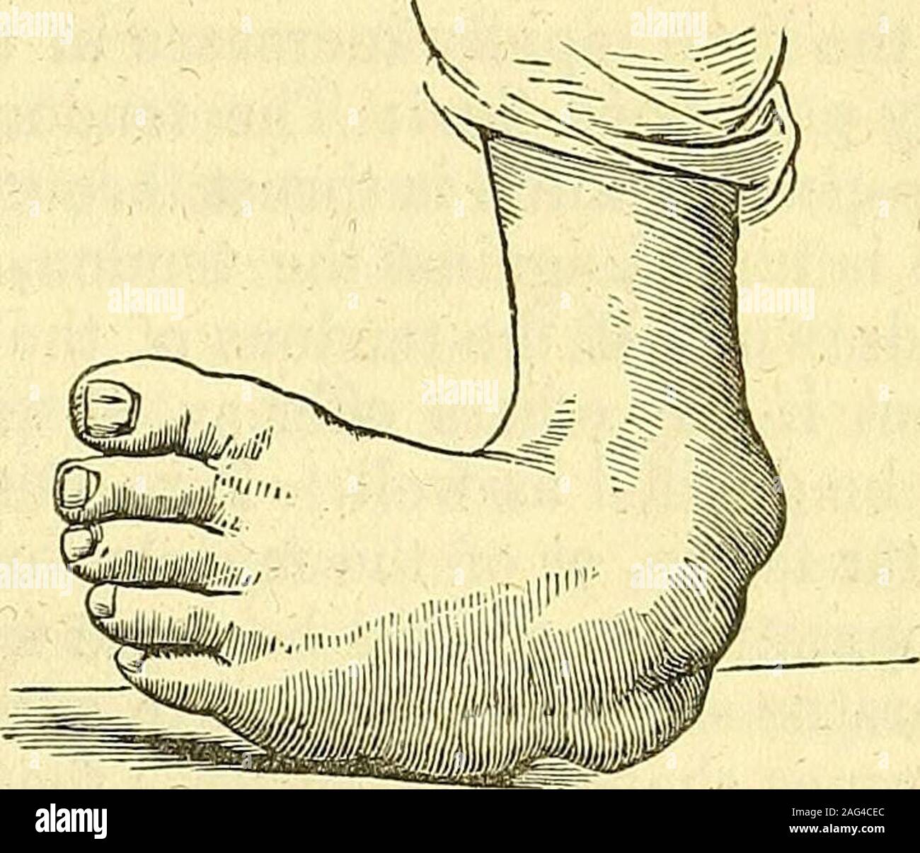 Talipes valgus hi-res stock photography and images - Alamy