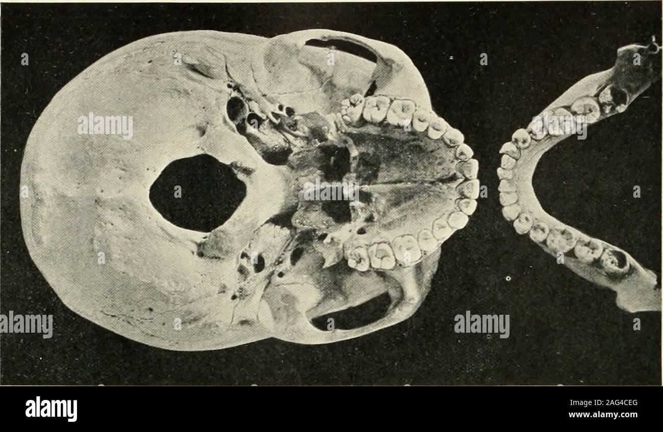 . The science and practice of dental surgery. Fig. 104.—Side view of ...