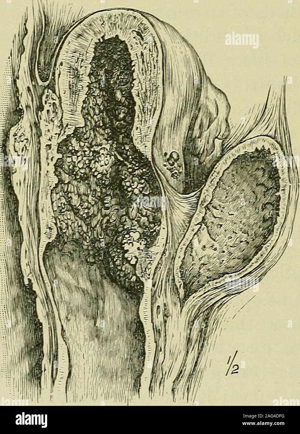 Secondary peritoneal cancer hi-res stock photography and images - Alamy