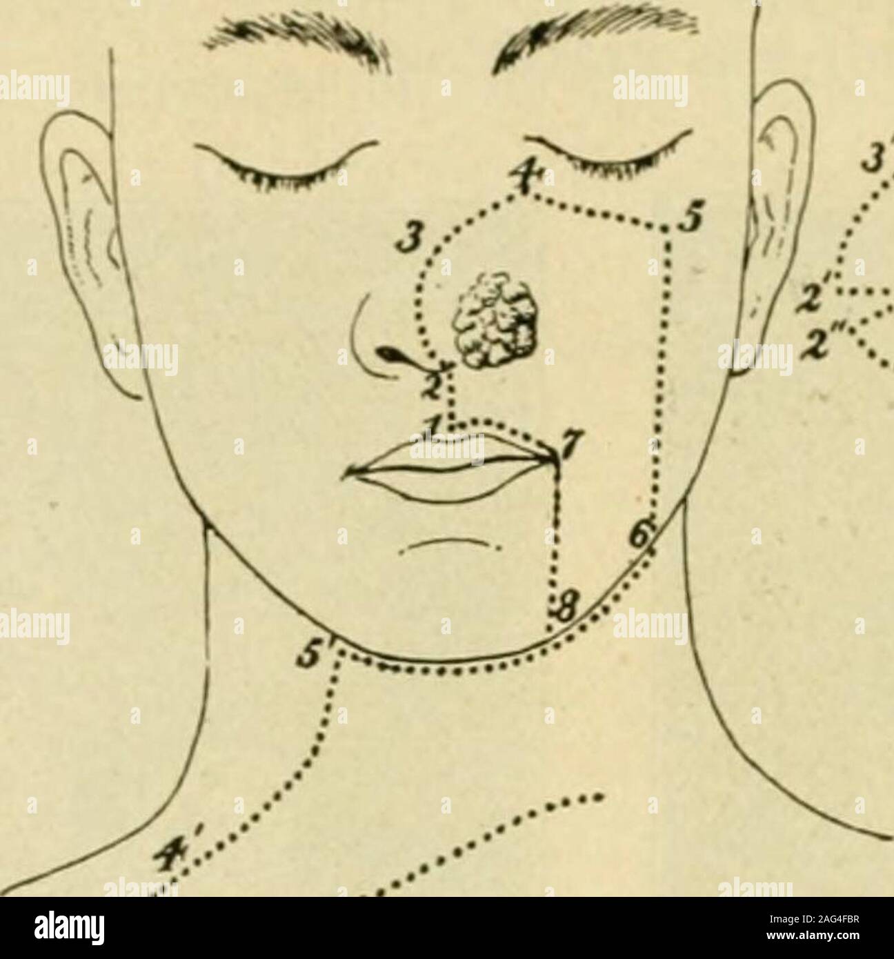 . Manual of operative surgery. utlined by the cuts 8-7-1-2-3-4-5-6 ...