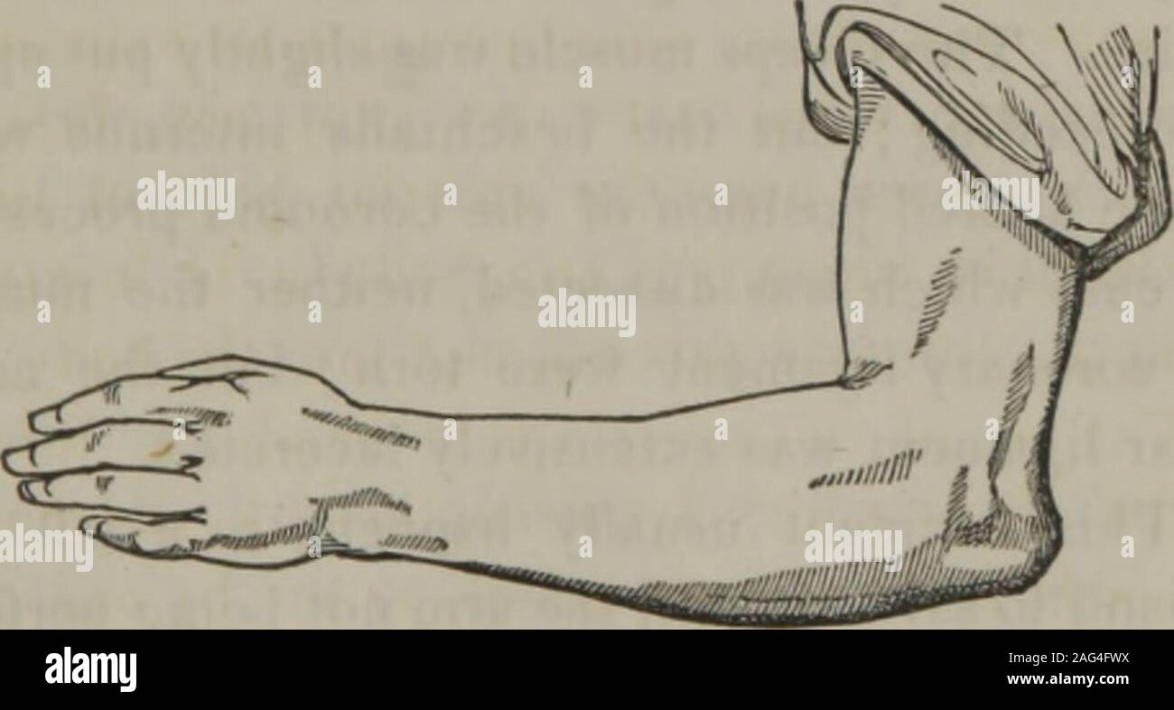 . A treatise on dislocations and fractures of the joints. THE ELBOW ...