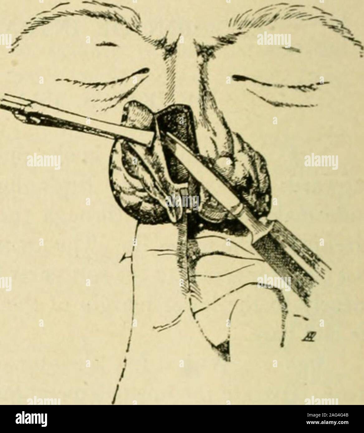 . Manual of operative surgery. js:Figs. 279 and 280.. -Rhinophyma ...