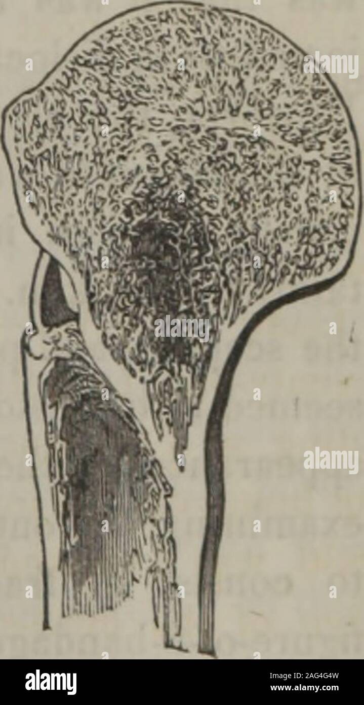 . A treatise on dislocations and fractures of the joints. s, the ...
