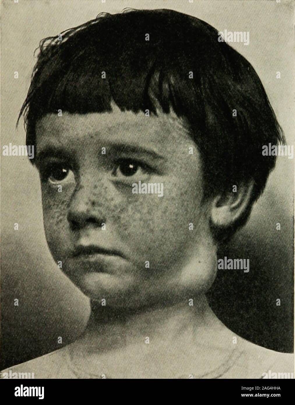 . The practice of pediatrics. the stage of suppuration. The ...