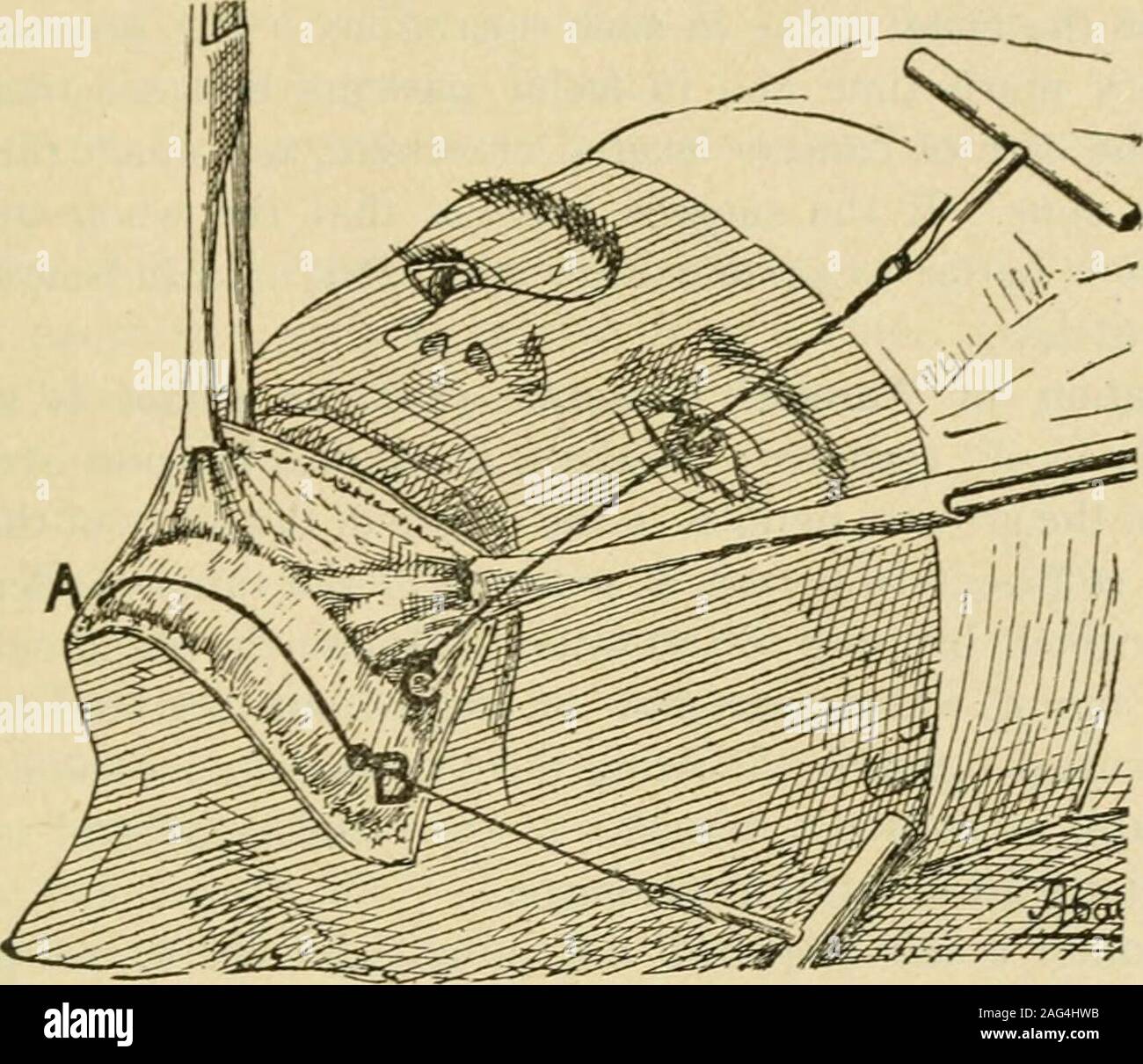 Amputation saw hi-res stock photography and images - Alamy