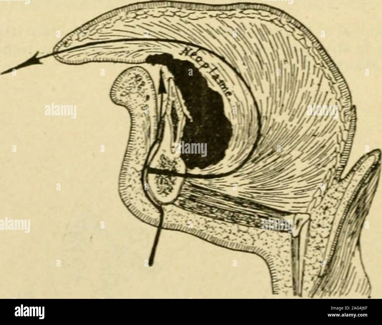 Thyrohyoid membrane hi-res stock photography and images - Alamy