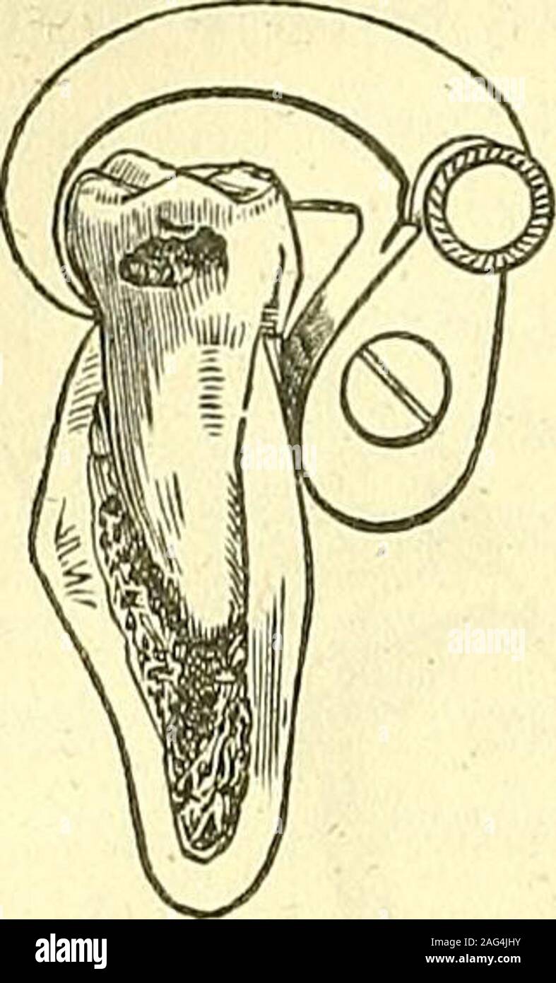 Tooth stumps hi-res stock photography and images - Alamy