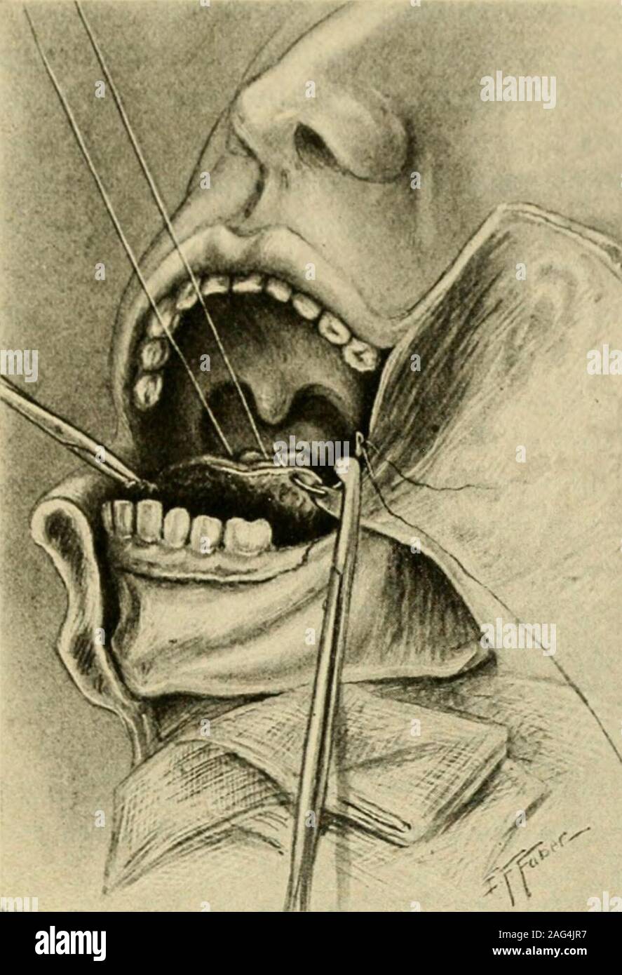 . Manual of operative surgery. FXCISION TONGUE 171. Fig. 266.—After ...