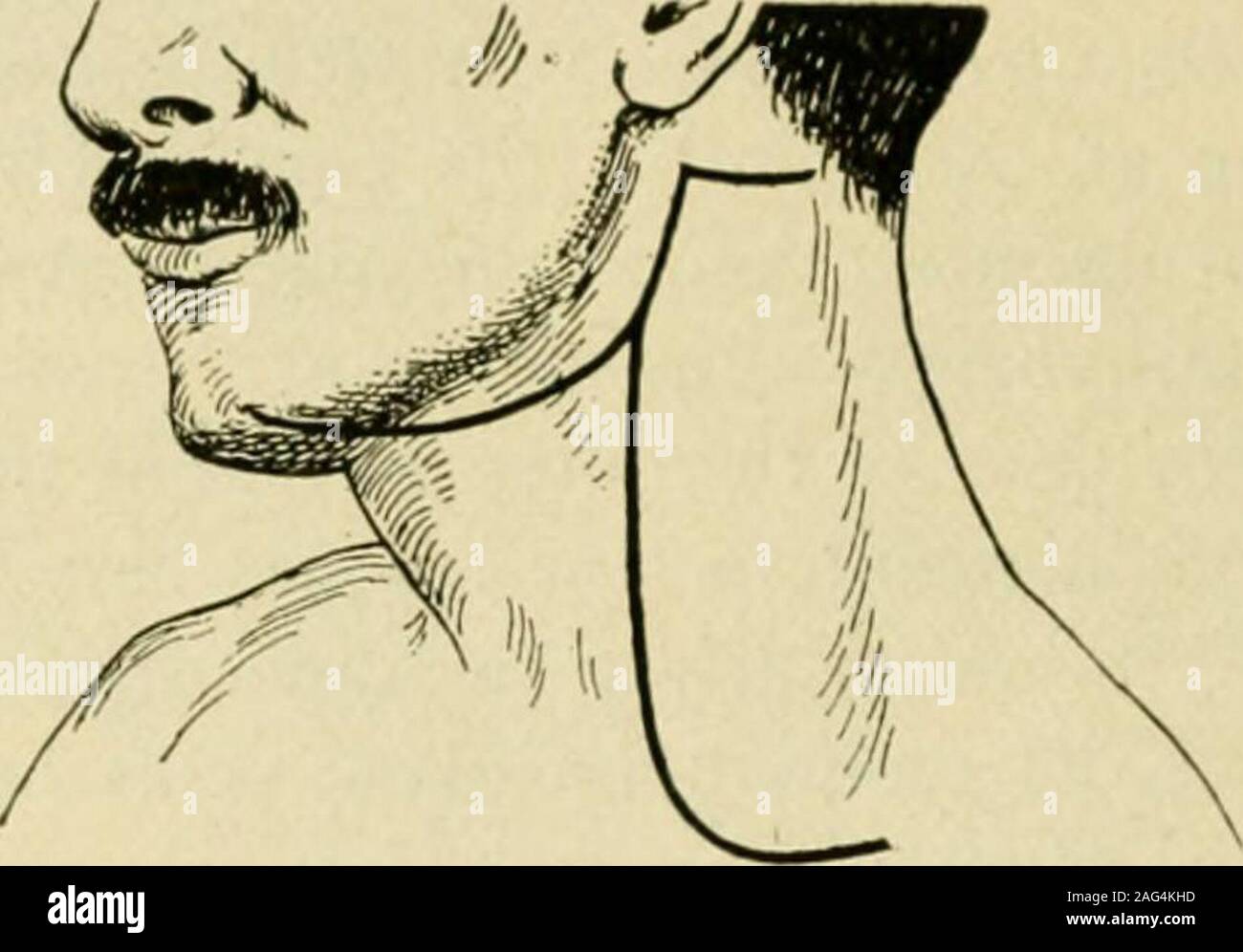 Sternomastoid hi-res stock photography and images - Alamy