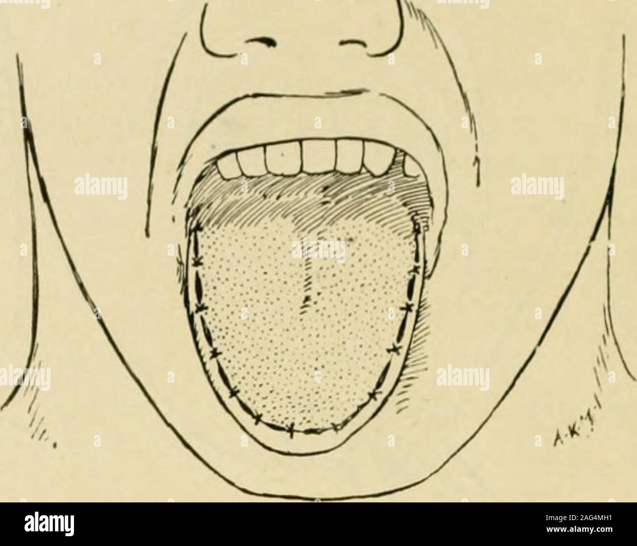 . Manual of operative surgery. Fig. 255.—Second stage. (By permission ...